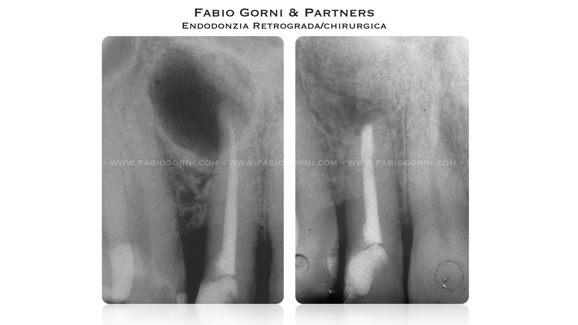 Endodonzia Retrograda/Chirurgica - Dr. Fabio Gorni